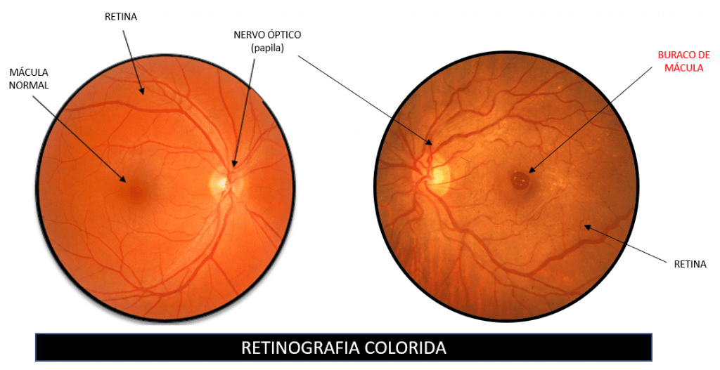 Cirurgia de Buraco Macular em Blumenau - Clínica de Olhos