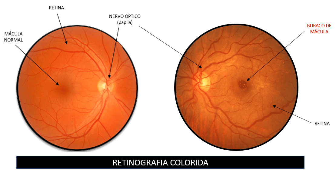 Cirurgia de Buraco Macular em Blumenau - Clínica de Olhos