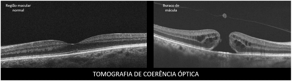Cirurgia de Buraco Macular em Blumenau - Clínica de Olhos