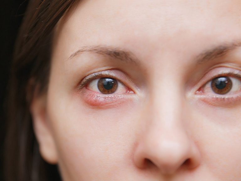 Cirurgia de Calázio em Blumenau - Clínica de Olhos