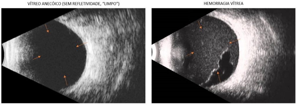 Cirurgia para Hemorragia Vítrea - von Hertwig Clínica e Hospital de Olhos