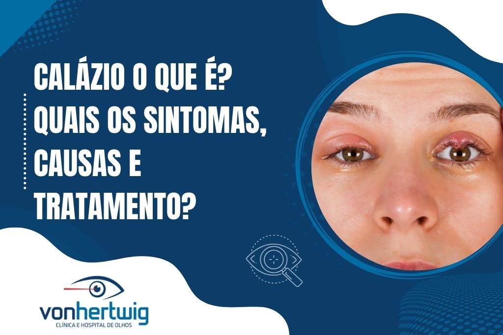 Calázio o que é? Quais os Sintomas, Causas e Tratamento?