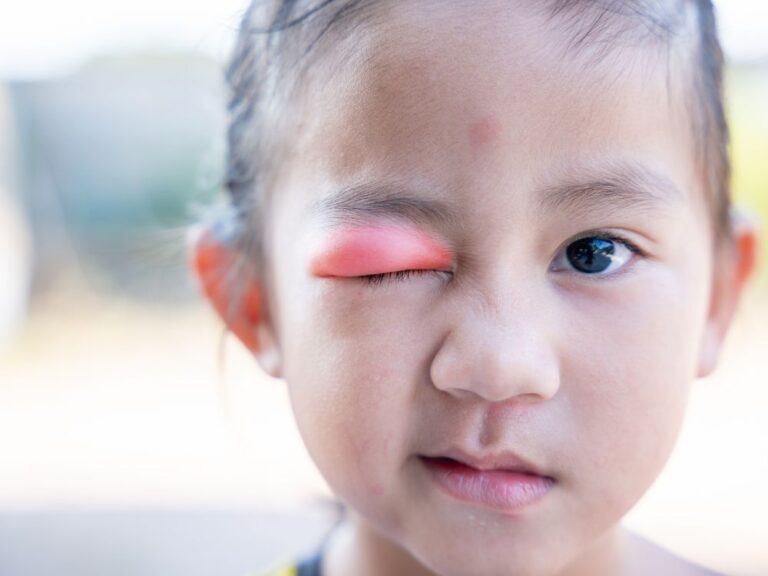 Calázio o que é? Quais os Sintomas, Causas e Tratamento?