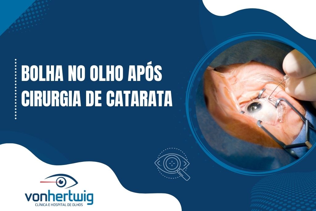 Bolha no olho após cirurgia de catarata: o que é?